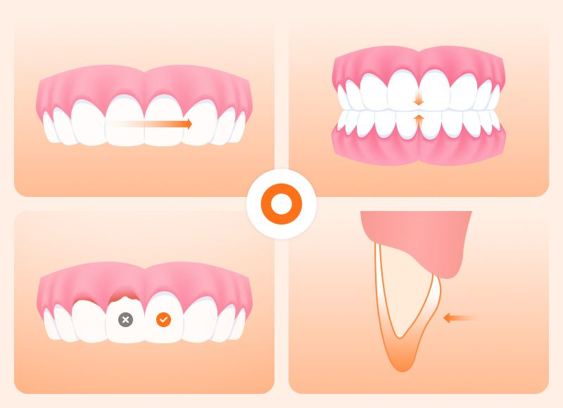 Can You Get Veneers in a Single Day? A Guide for International Patients ...
