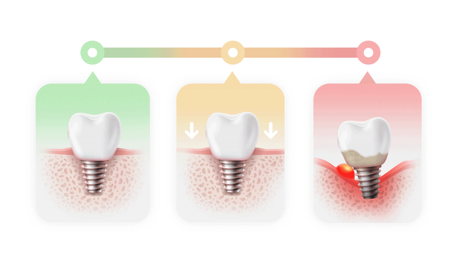 Peri-Implantitis Warning Signs: A Practical Self-Check and Treatment Guide